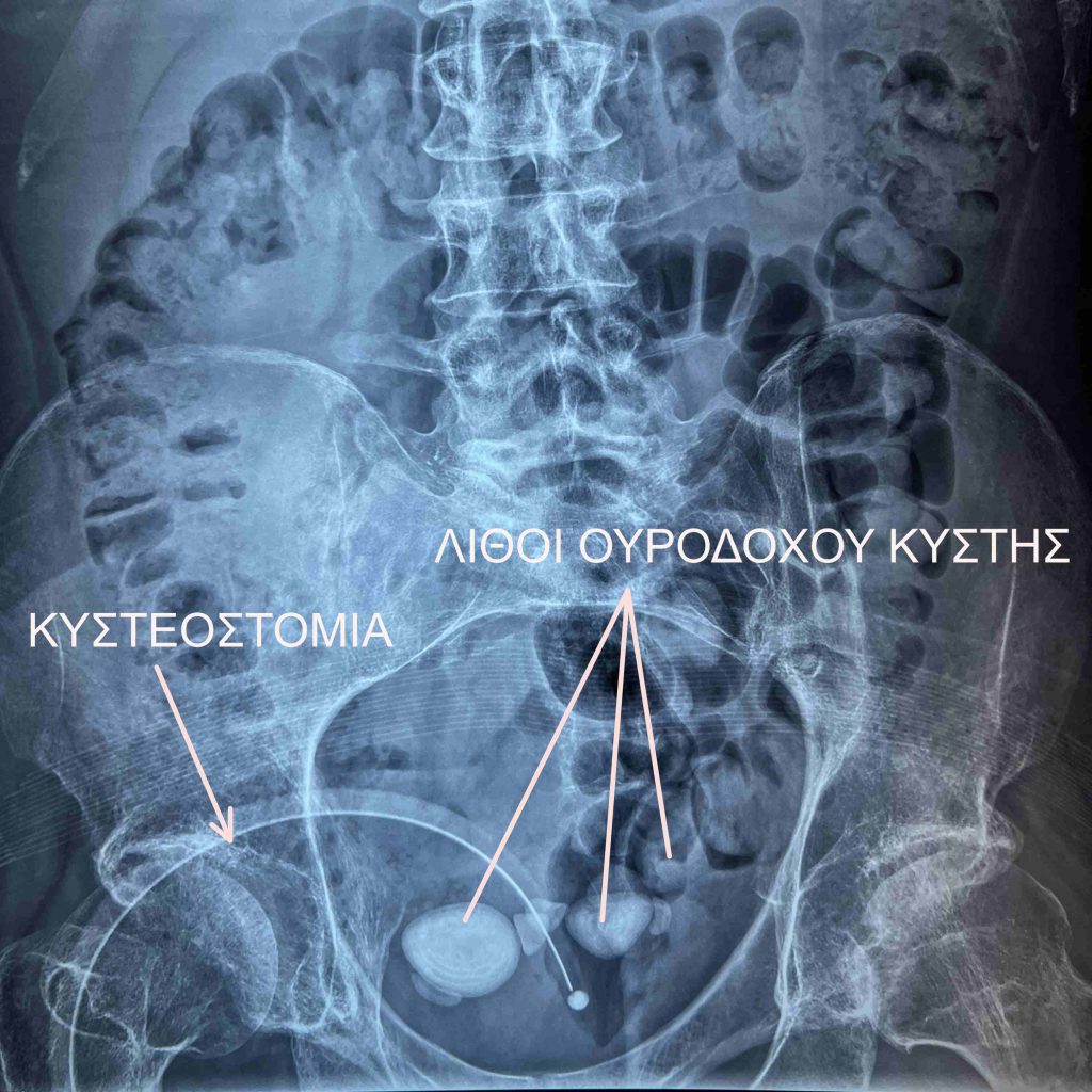 Ουρολόγοι Θεσσαλονίκη: Υπέρηχο ουροδόχου κύστης